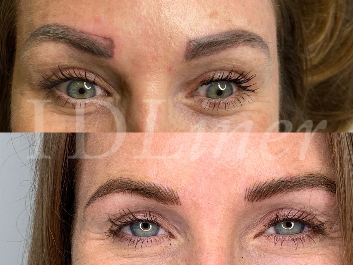 Permanent Makeup Removal Training Courses - ID Liner – ID Liner Pro PMU USA